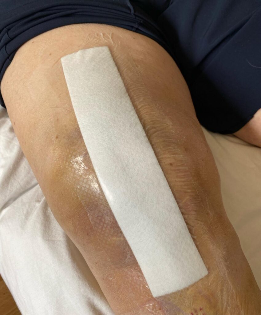 From Surgery to Strength: Why Physiotherapy at Home Matters Post-Op ...